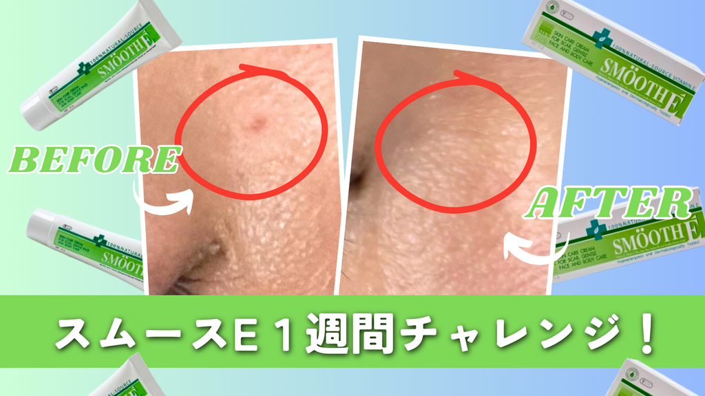 スムースEクリーム1週間つかってみた！どこに売ってる？ニキビ跡への効果はいかに！: styme（スタイミー）